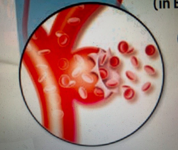 Life after a Stroke - Seniors Today